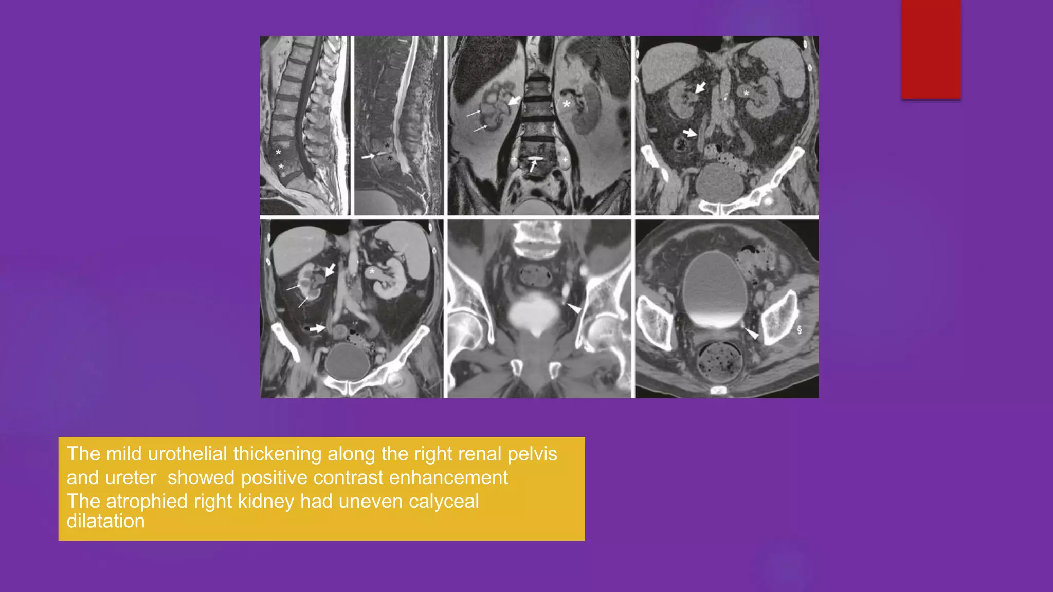 Role of imaging in urosepsis | PPT
