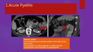 Role of imaging in urosepsis | PPT
