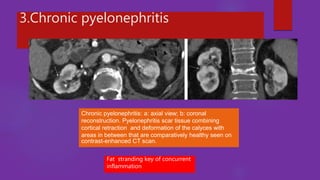 Role of imaging in urosepsis | PPTX