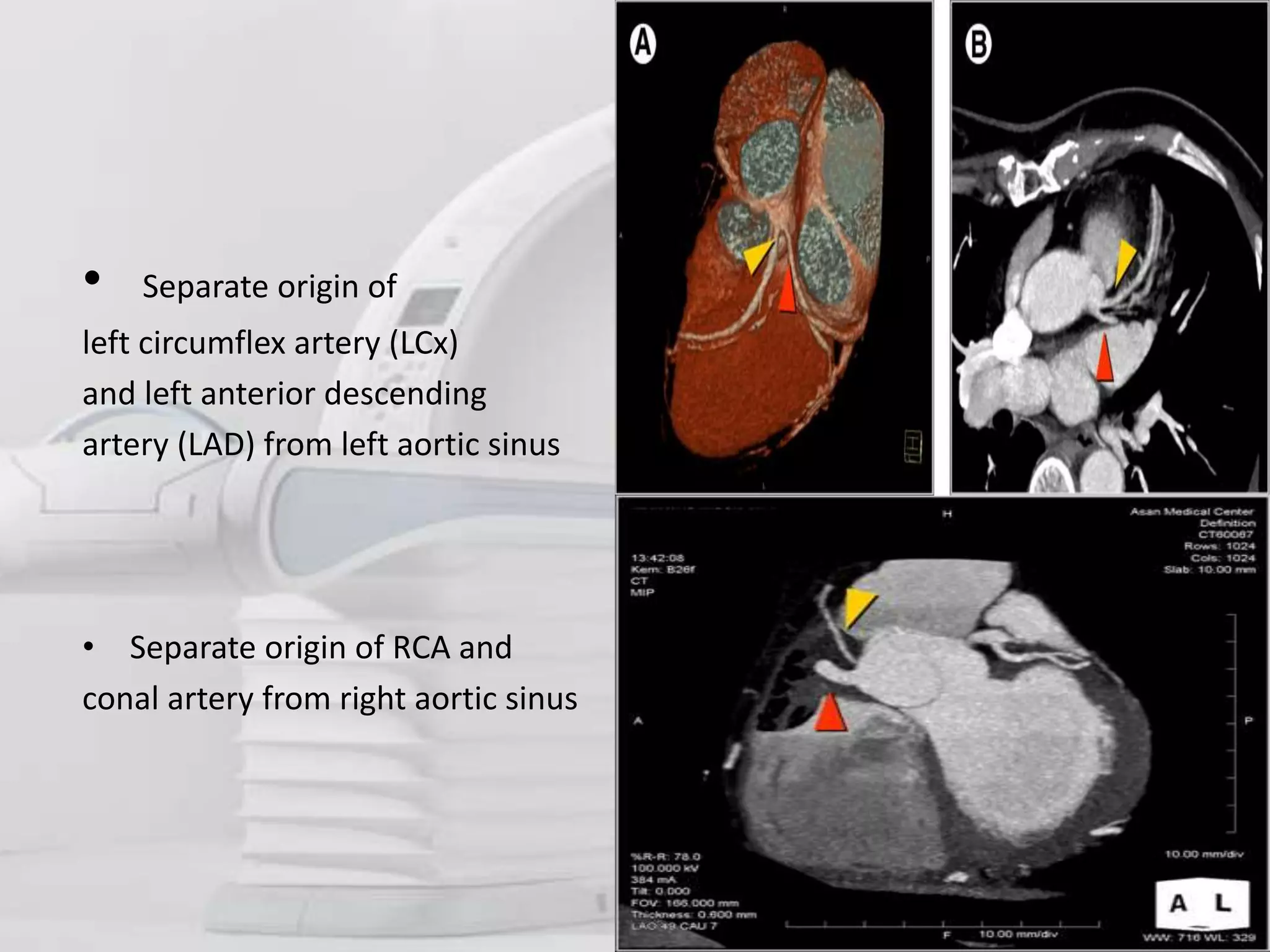 Role of ct angiography in diagnosis of coronary anomalies | PPT