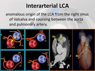 Role of ct angiography in diagnosis of coronary anomalies | PPTX