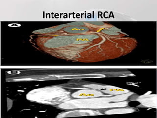 Role of ct angiography in diagnosis of coronary anomalies | PPTX
