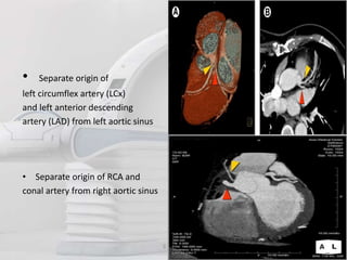 Role of ct angiography in diagnosis of coronary anomalies | PPTX