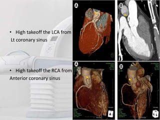 Role of ct angiography in diagnosis of coronary anomalies | PPTX