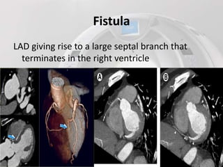 Role of ct angiography in diagnosis of coronary anomalies | PPTX
