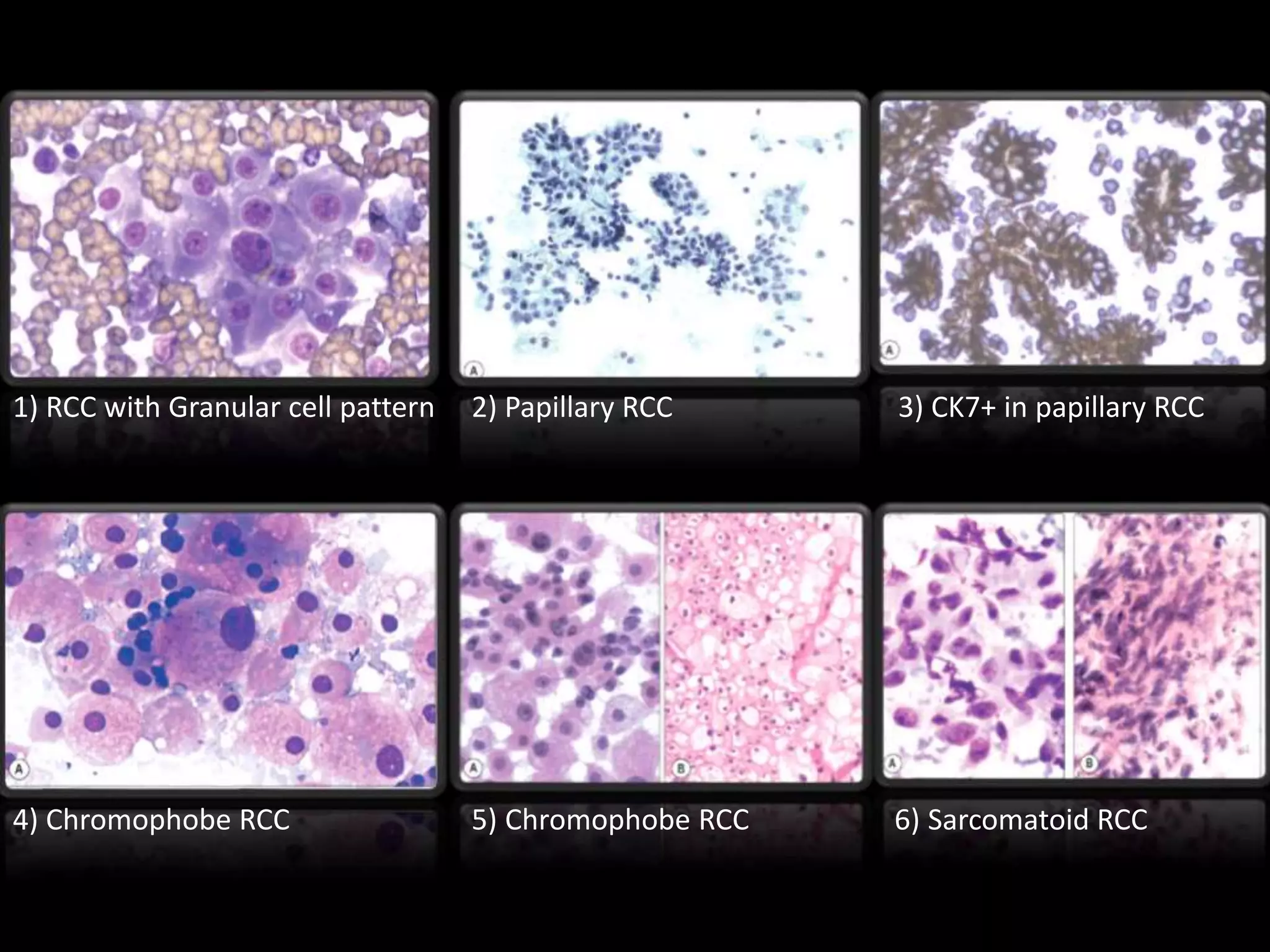 Role of cytology in renal lesions | PPTX