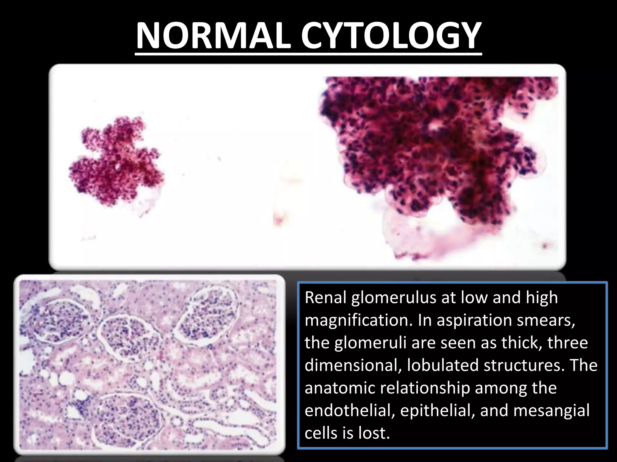 Role of cytology in renal lesions | PPTX