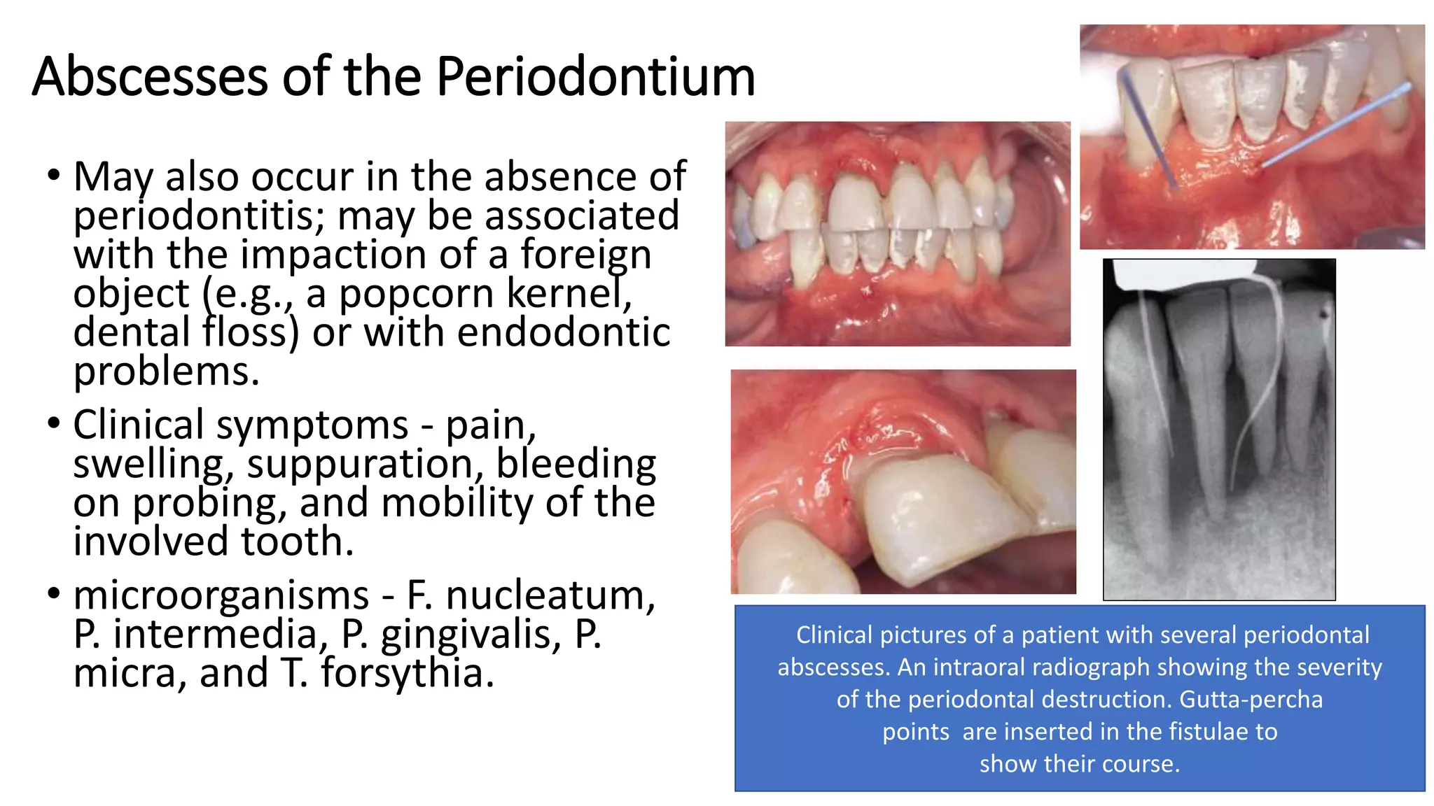 Role of dental biofilm in pathogenesis of periodontal | PPTX