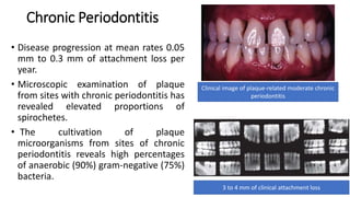 Role of dental biofilm in pathogenesis of periodontal | PPTX