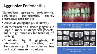 Role of dental biofilm in pathogenesis of periodontal | PPTX