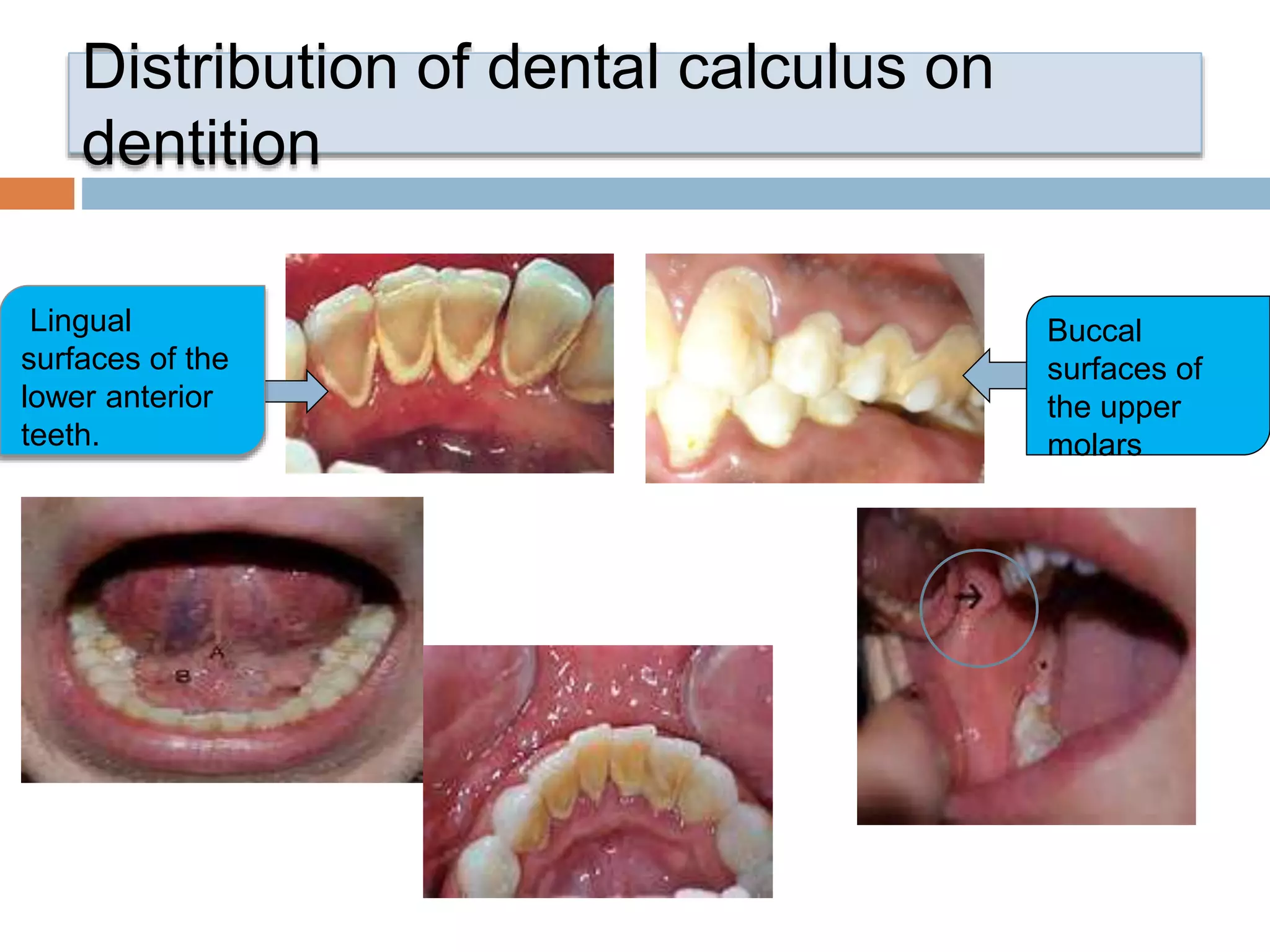 role of dental calculus DR SINDHURA.pptx