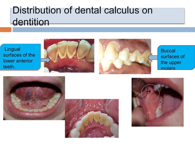 role of dental calculus DR SINDHURA.pptx | Dental Health | Diseases and ...