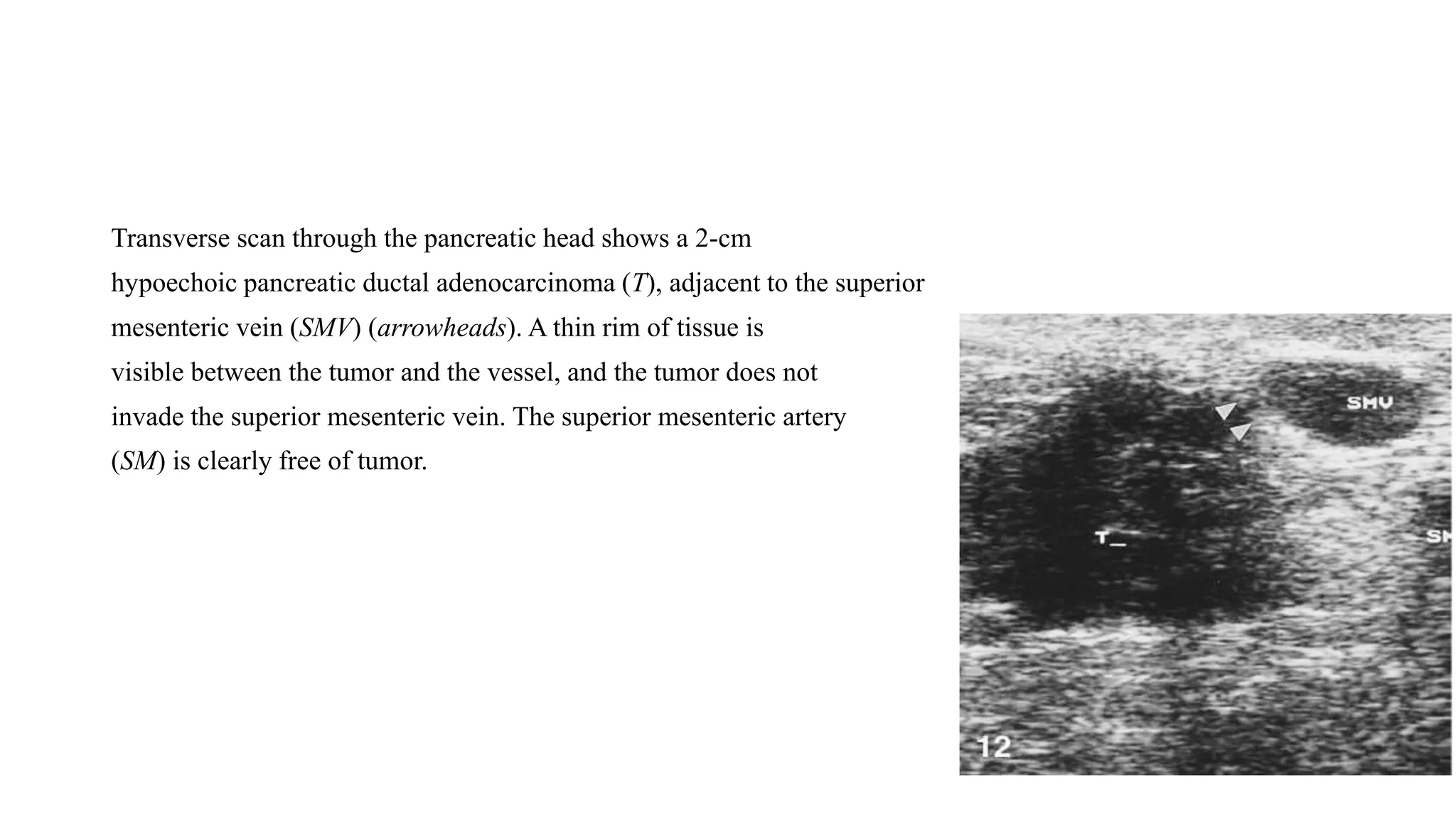 ROLE OF DIAGNOSTIC LAPROSCOPY IN ABDOMINAL MALIGNANCIES.pptx