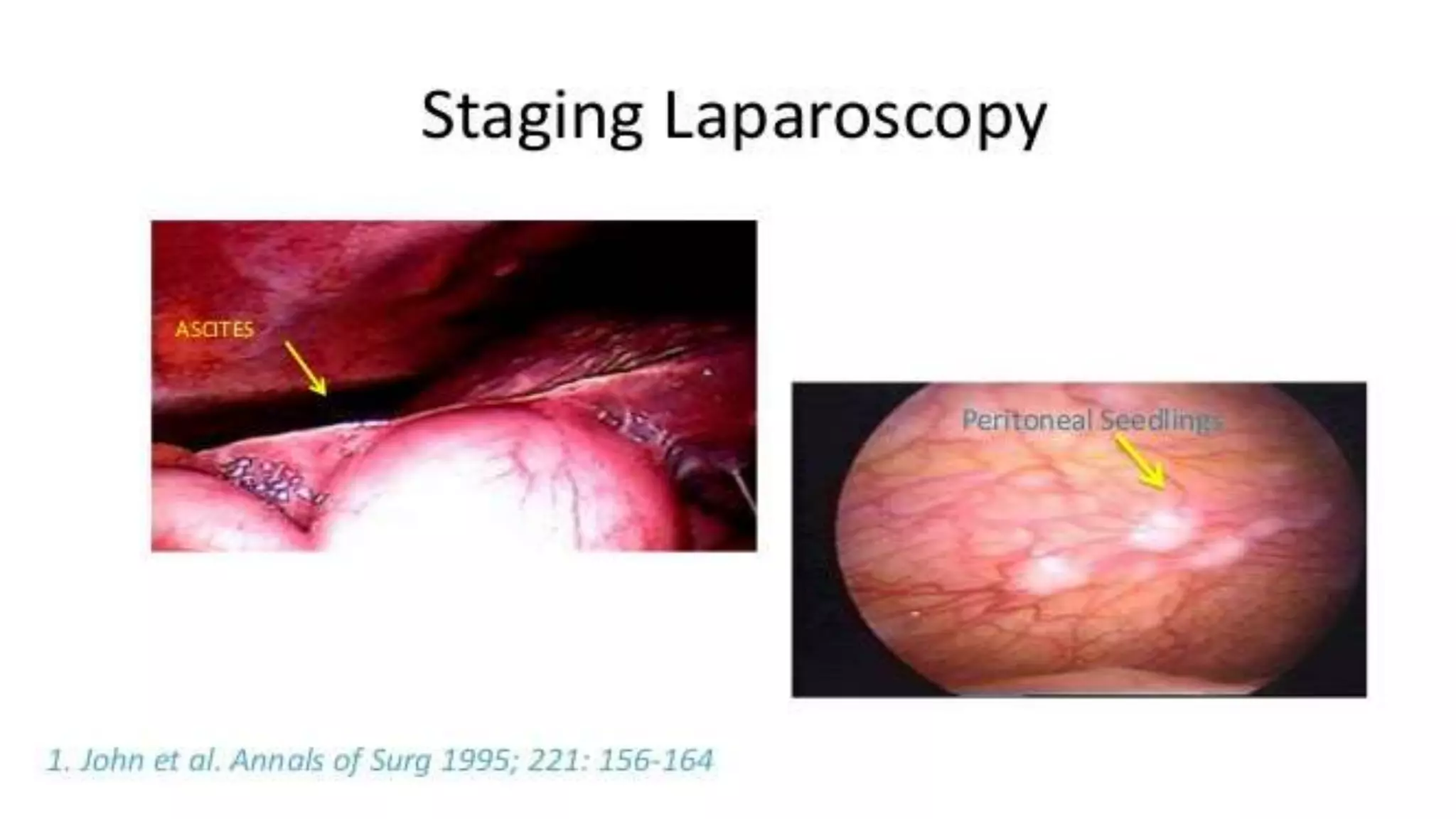 ROLE OF DIAGNOSTIC LAPROSCOPY IN ABDOMINAL MALIGNANCIES.pptx