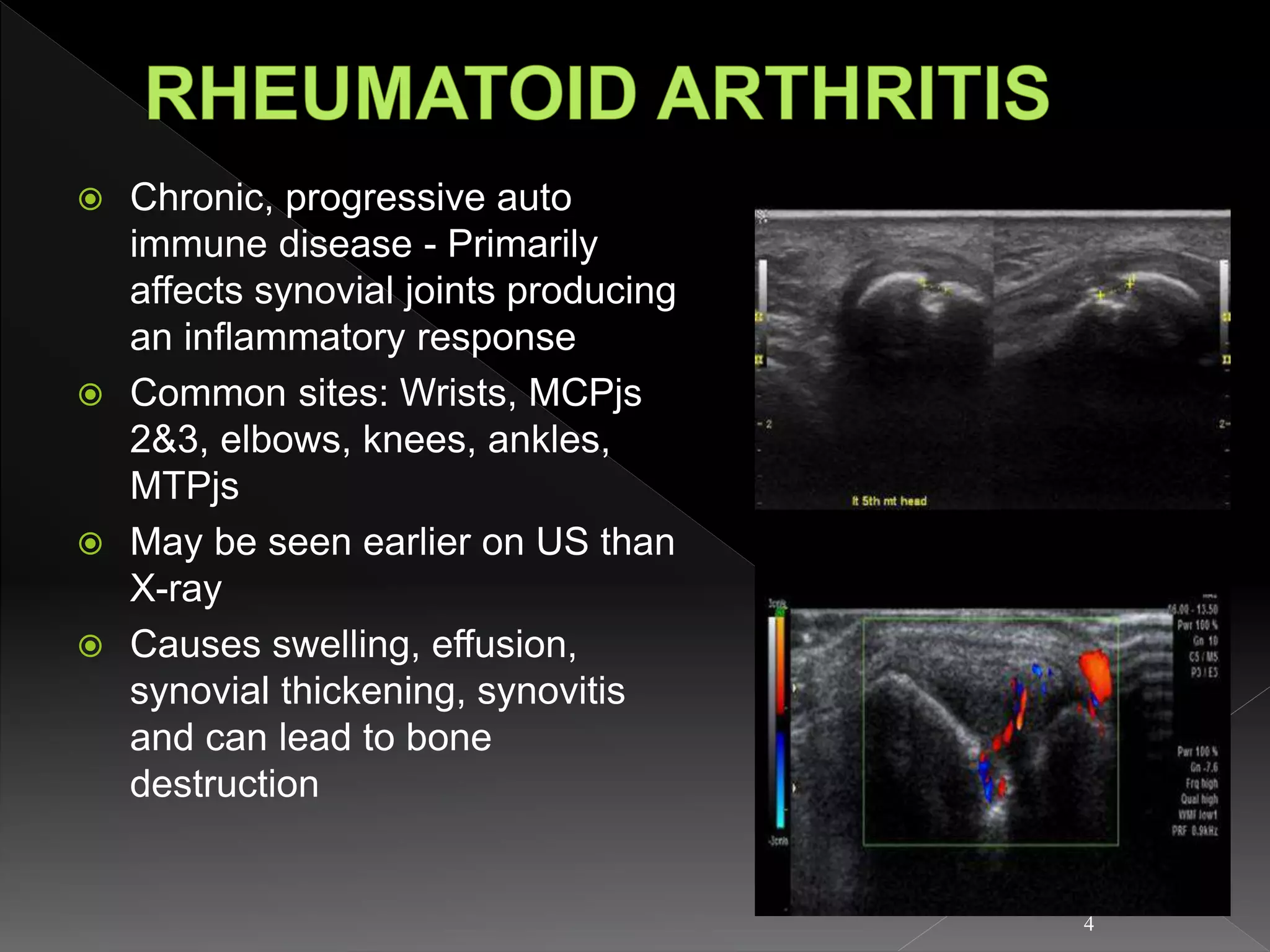 Role of Diagnostic Ultrasound in Rheumatology.ppt