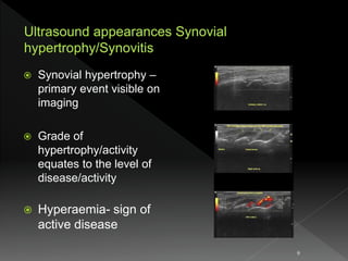 Role of Diagnostic Ultrasound in Rheumatology.ppt | Physical Therapy ...