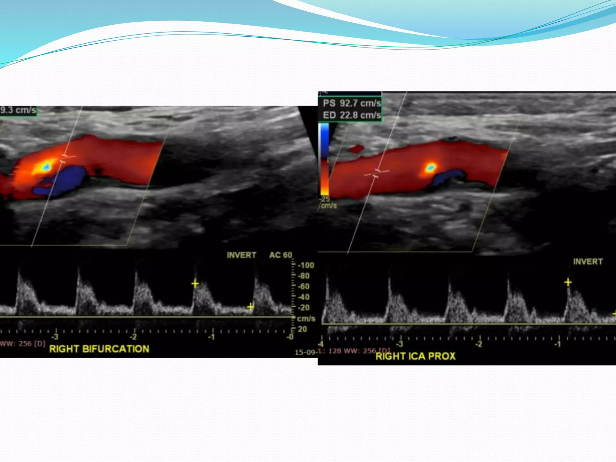 Role of doppler in acute vasclar emergencies dr.rupa