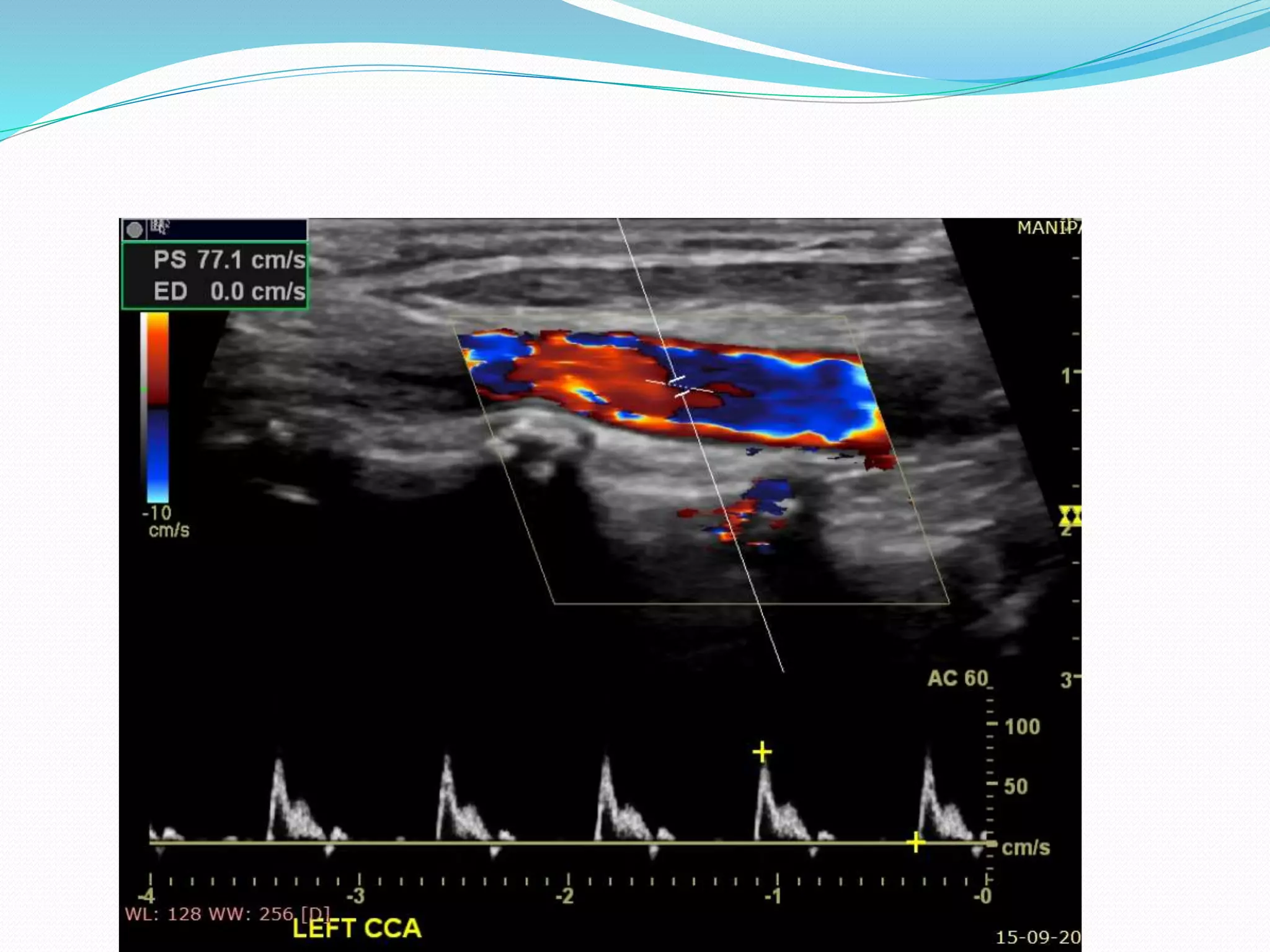 Role of doppler in acute vasclar emergencies dr.rupa