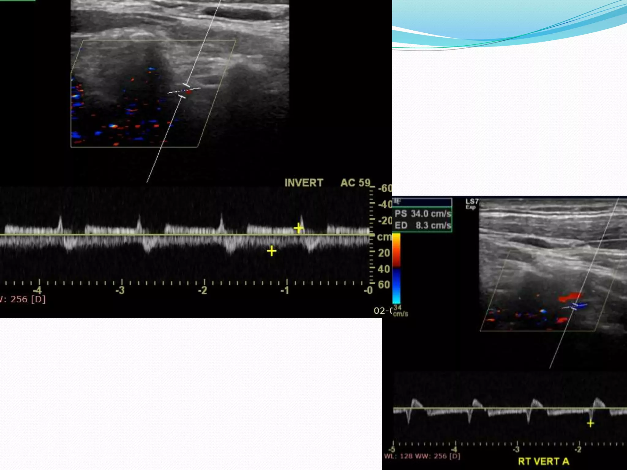 Role of doppler in acute vasclar emergencies dr.rupa