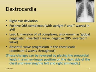 Role of ecg in pulmonology | PPTX