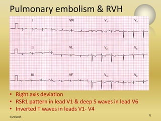 Role of ecg in pulmonology | PPT