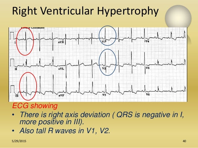 Role of ecg in pulmonology