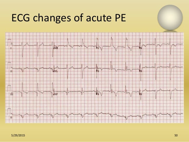 Pe ecg findings - pikoltap
