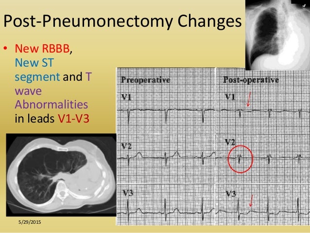 Role of ecg in pulmonology