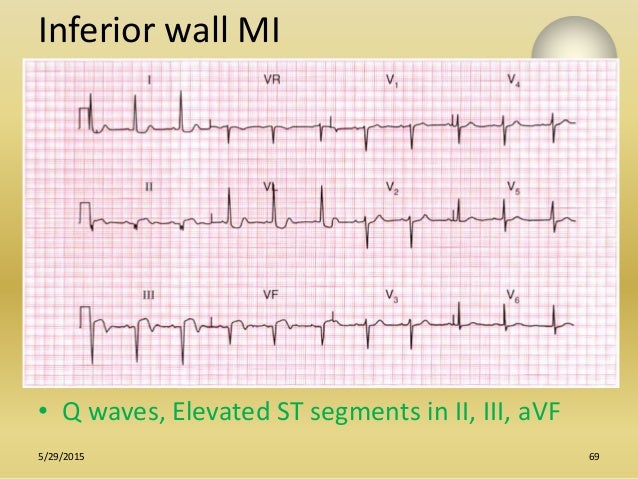 Role of ecg in pulmonology
