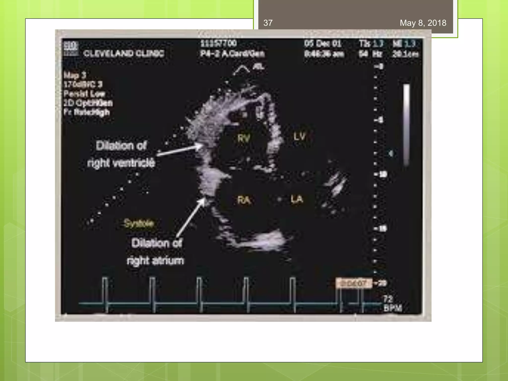 Role of echocardiography in acute myocardial infraction | PPT