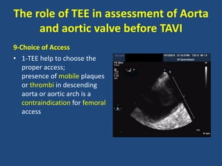 Role of echo in tavi | PDF