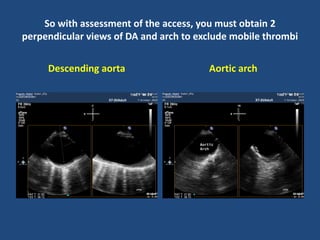 Role of echo in tavi | PDF