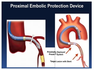 Role of embolic protection device in coronary and carotid intervention ...