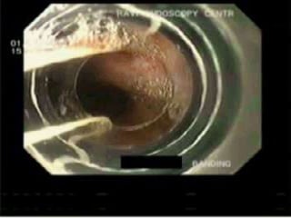 Role of emergency endoscopy in saving lives dr ravi gupta | PPTX