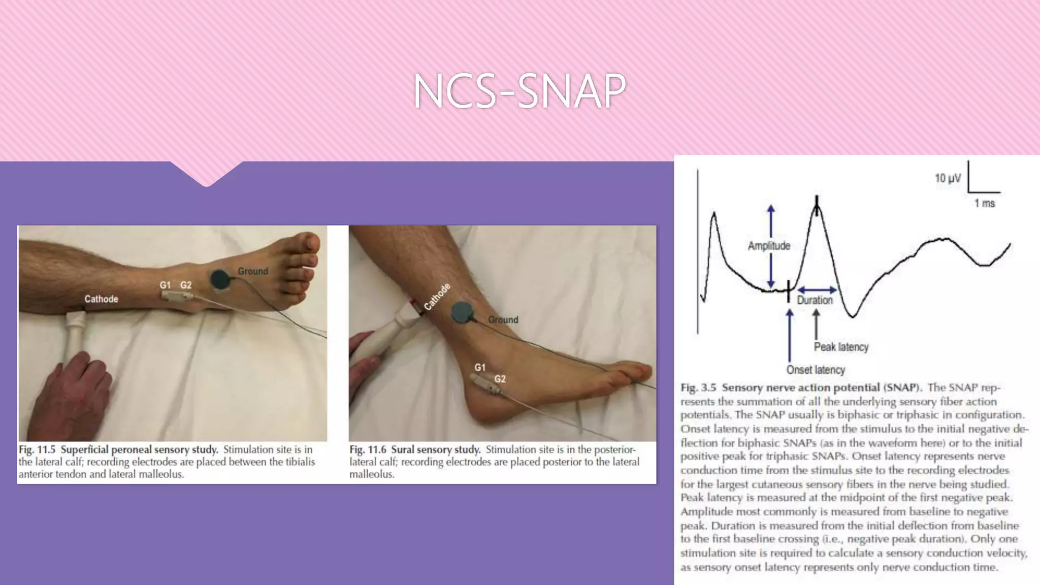 Role of EMG-NCS in piriformis syndrome.pptx