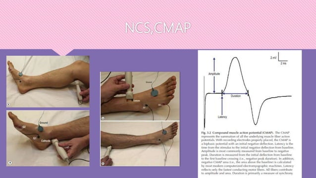 Role of EMG-NCS in piriformis syndrome.pptx
