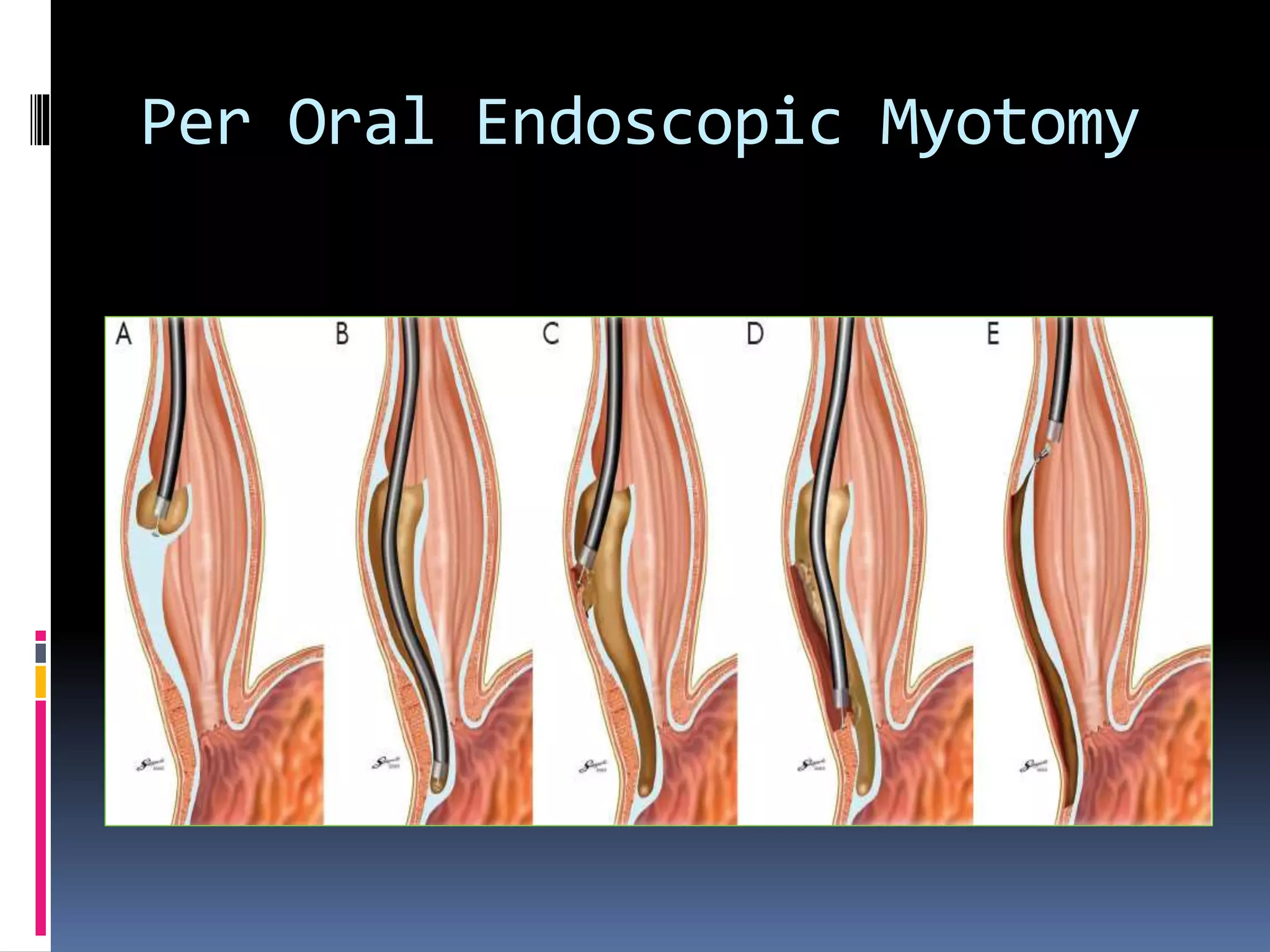 Role of endoscopy in achalasia and gerd | PPTX