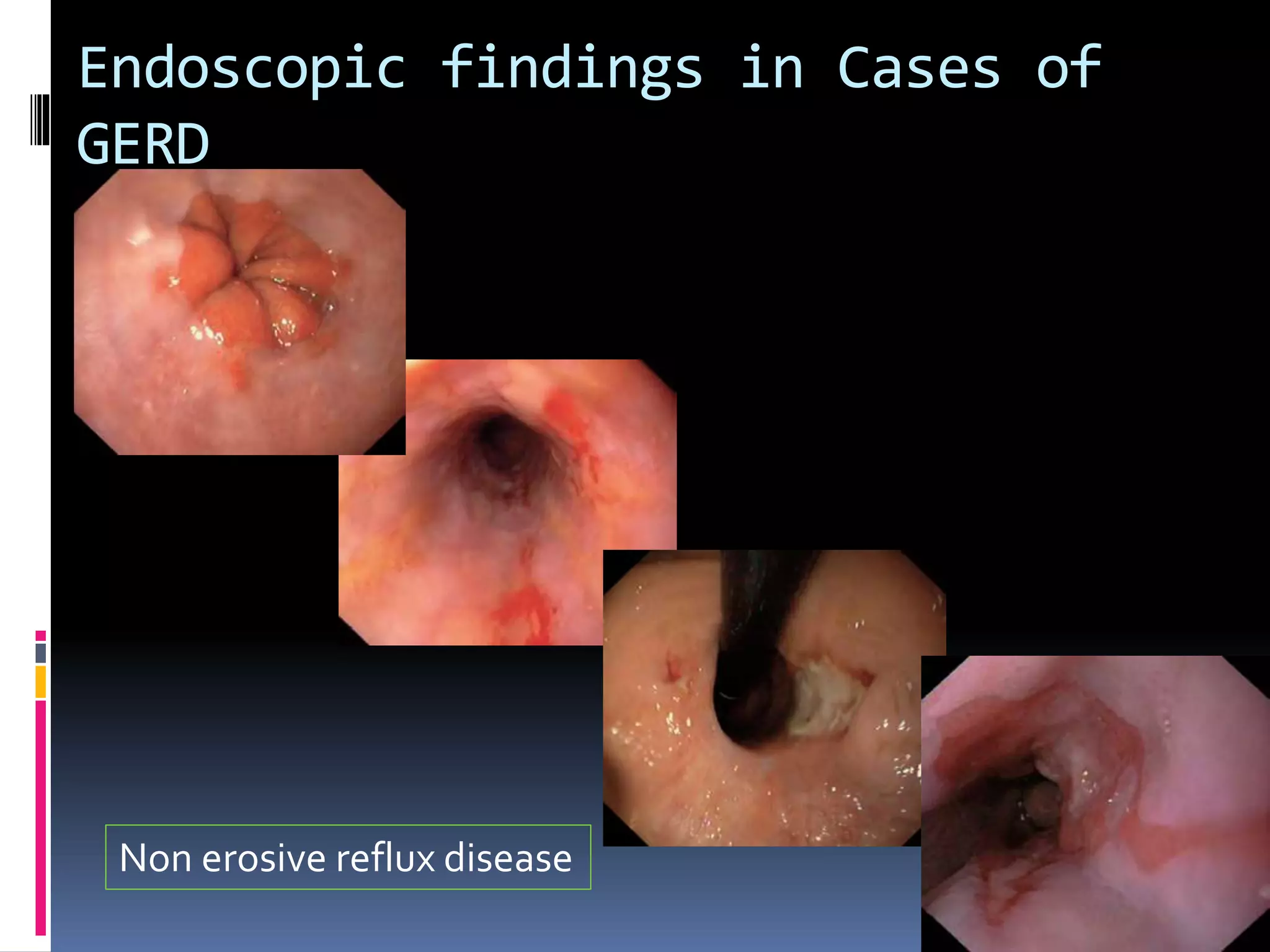 Role of endoscopy in achalasia and gerd | PPTX