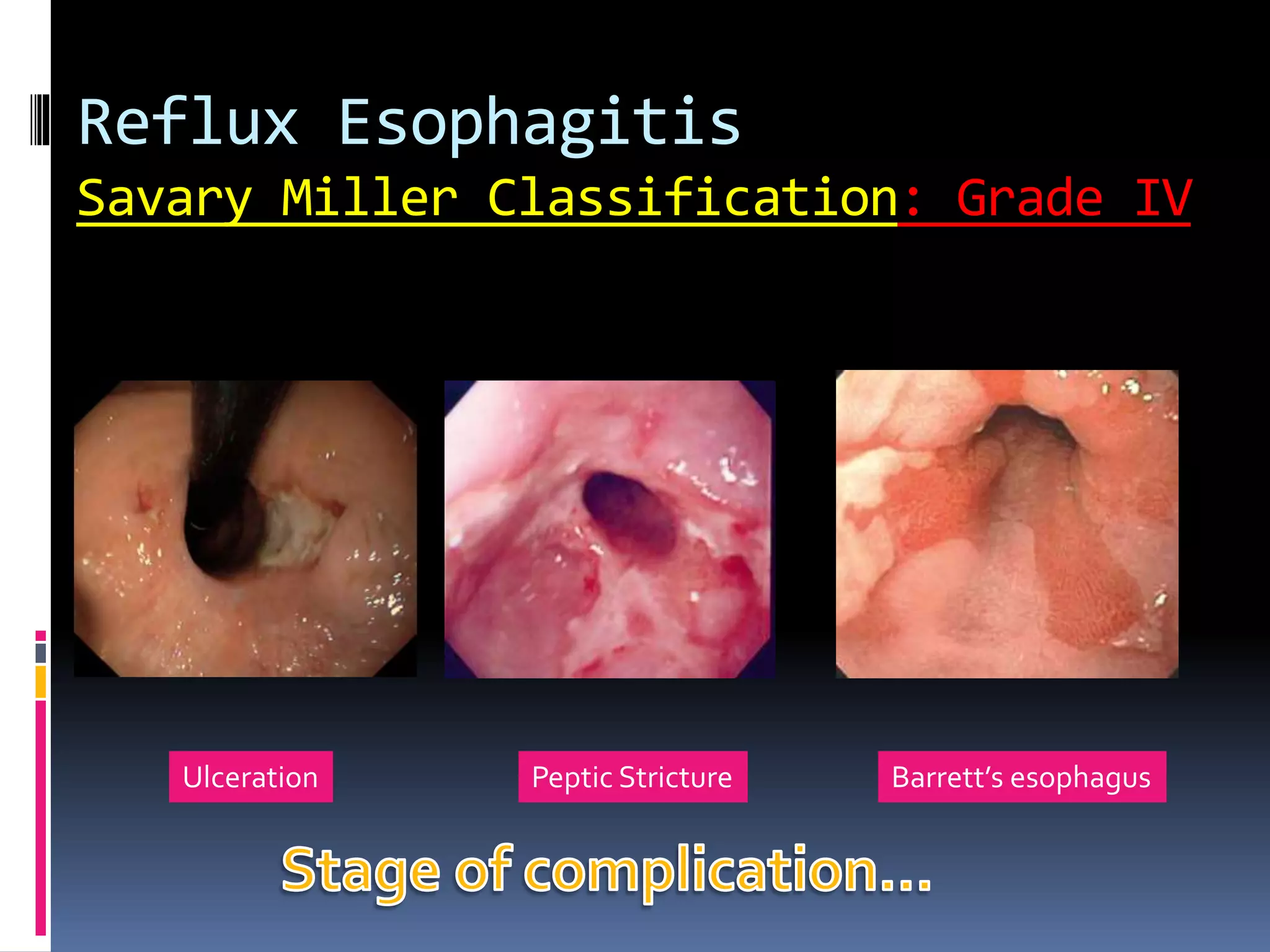 Role of endoscopy in achalasia and gerd | PPTX