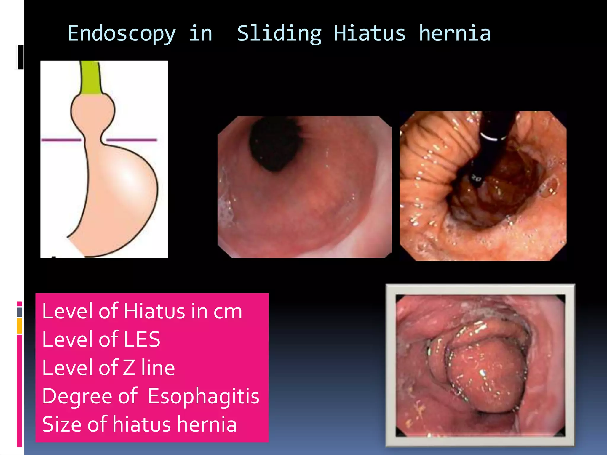 Role of endoscopy in achalasia and gerd | PPTX