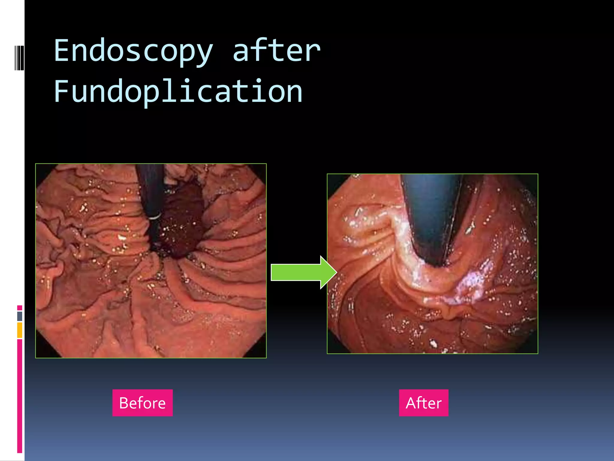 Role of endoscopy in achalasia and gerd | PPTX