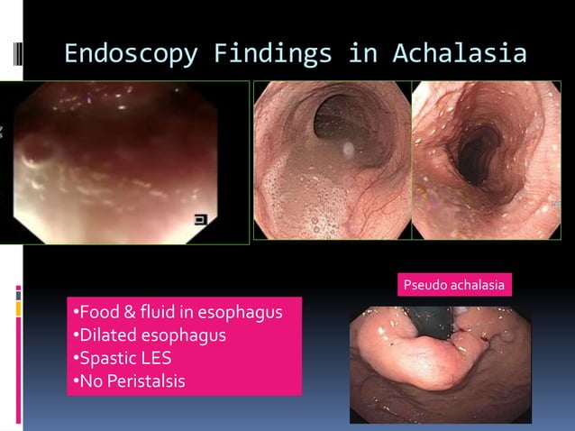 Role of endoscopy in achalasia and gerd | PPTX