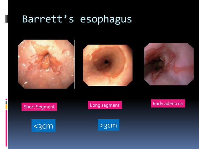 Role of endoscopy in achalasia and gerd | PPTX