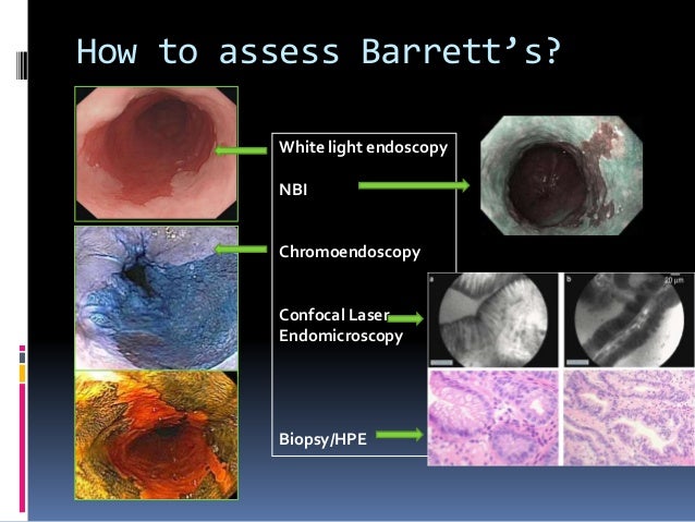 Role of endoscopy in achalasia and gerd
