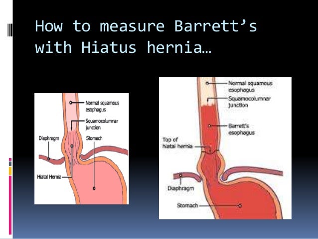 Role of endoscopy in achalasia and gerd