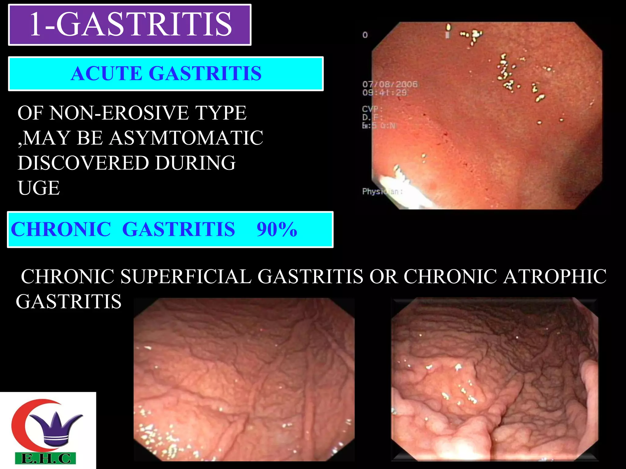 Role of endoscopy in management of h pylori disorders | PPT | Free Download