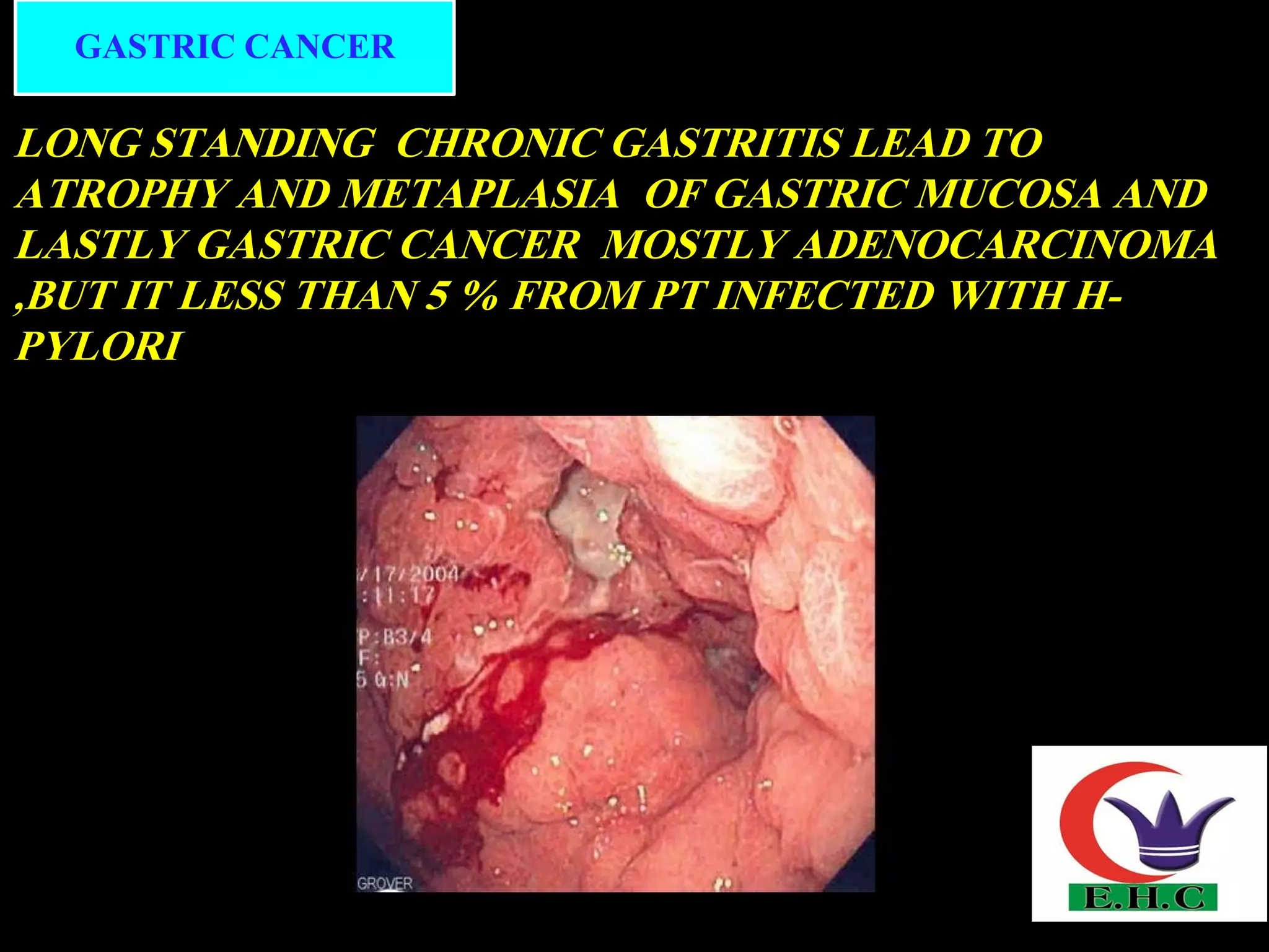 Role of endoscopy in management of h pylori disorders | PPT | Free Download