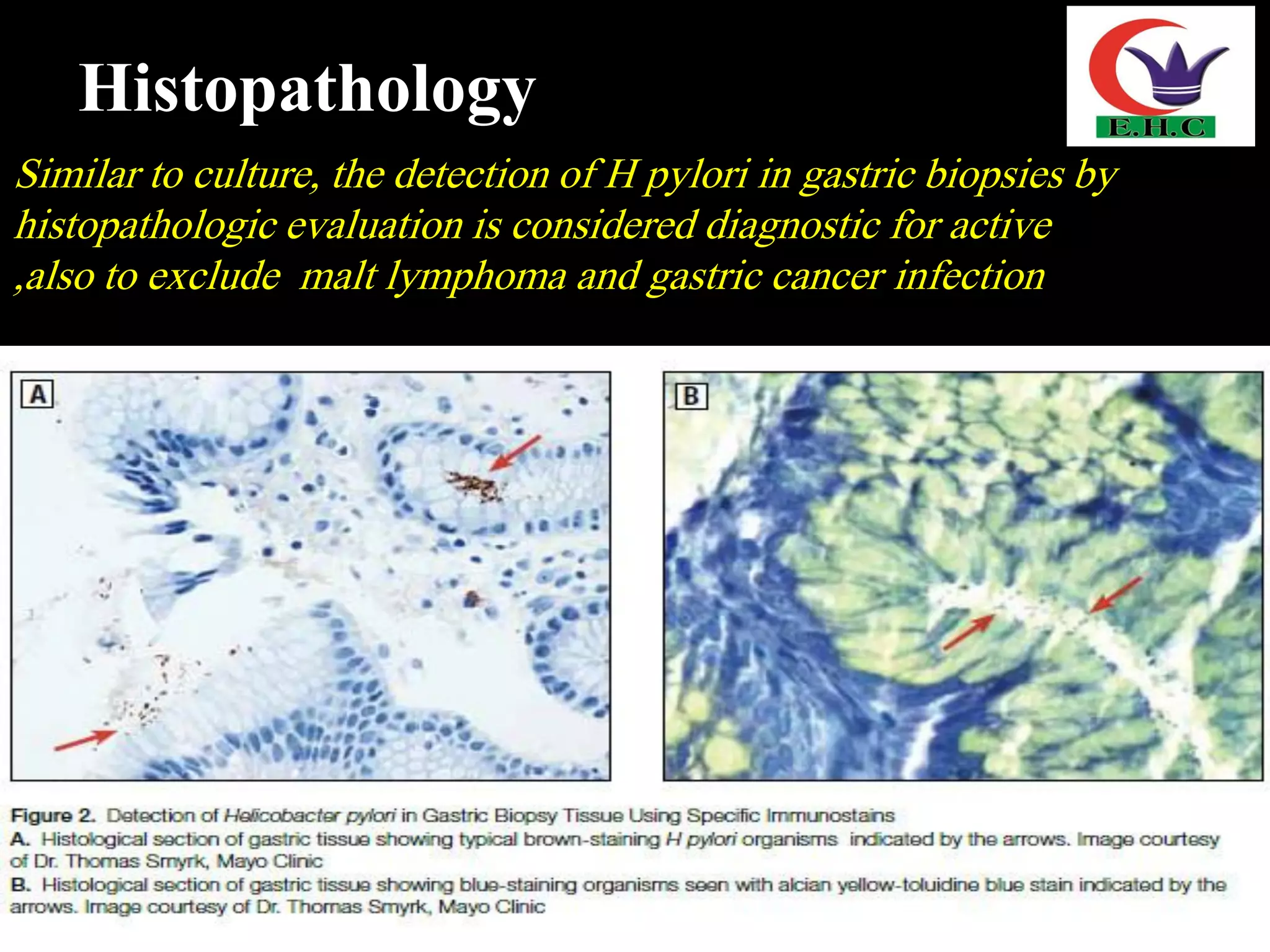 Role of endoscopy in management of h pylori disorders | PPT | Free Download