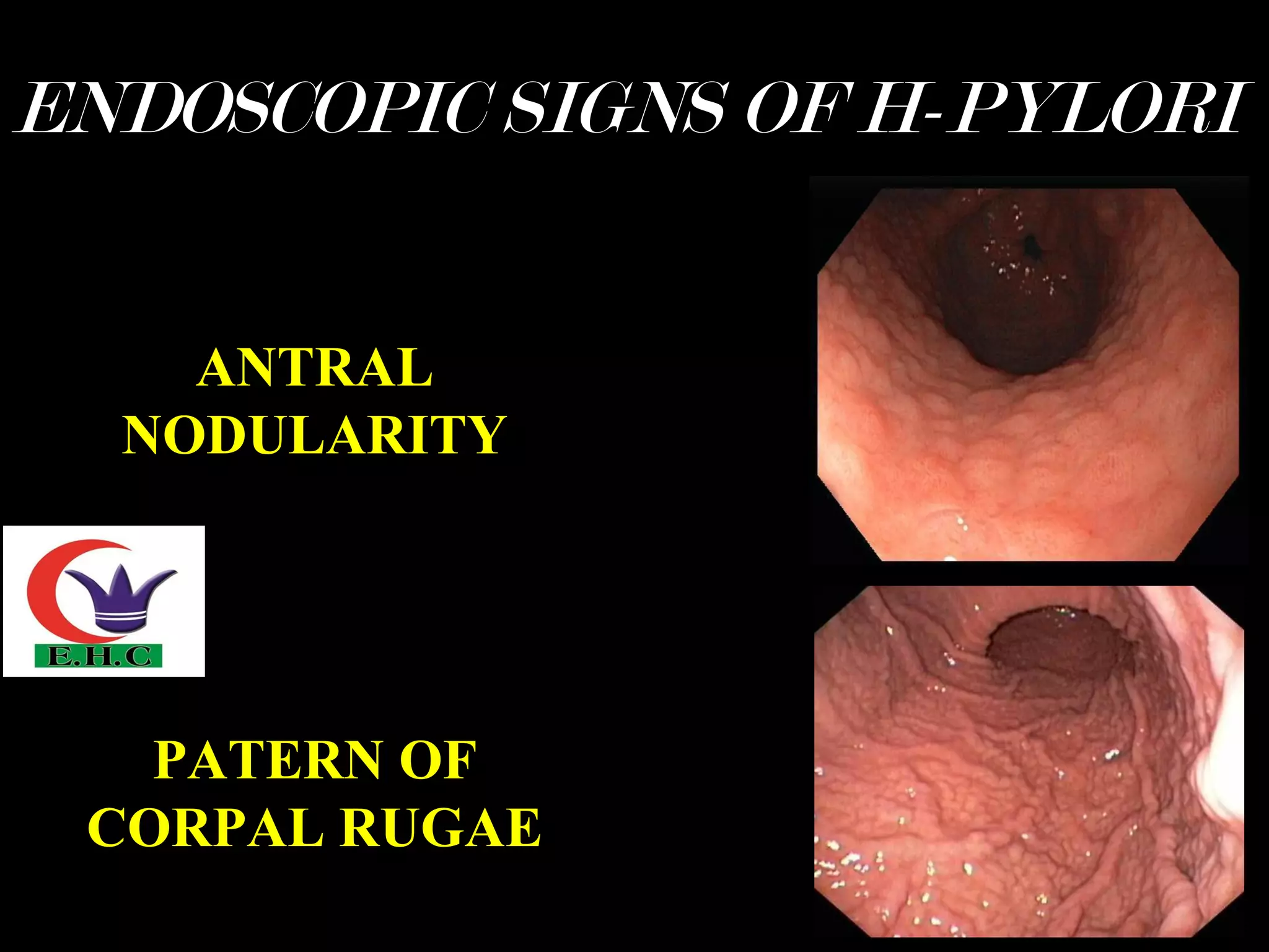 Role of endoscopy in management of h pylori disorders | PPT