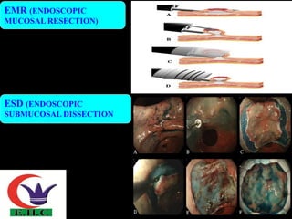 Role of endoscopy in management of h pylori disorders | PDF